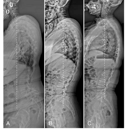 Figure 1 From How Does Sagittal Spinopelvic Alignment Of Lumbar