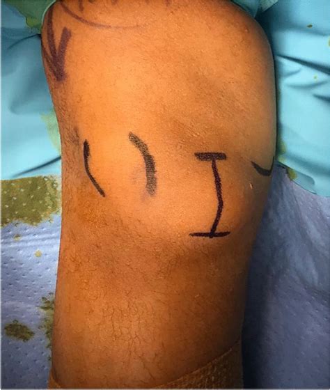 The Soft Tissue Mass After The Excision Download Scientific Diagram