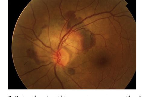 [pdf] Regression Of Peripapillary Choroidal Neovascular Membrane In A Patient With Sarcoidosis