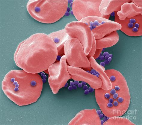 Strep A Infection 1 By Science Photo Library