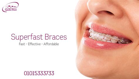 Superfast Braces Cairo