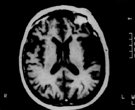 Mri Transaxial Image Showing Bilateral Frontal And Temporal Lobes Download Scientific Diagram