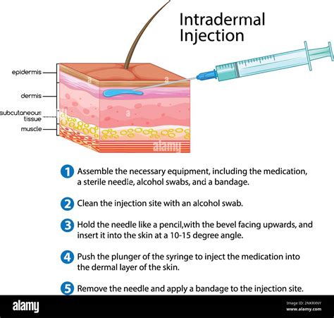Intradermal Injection With Explanation Illustration Stock Vector Image