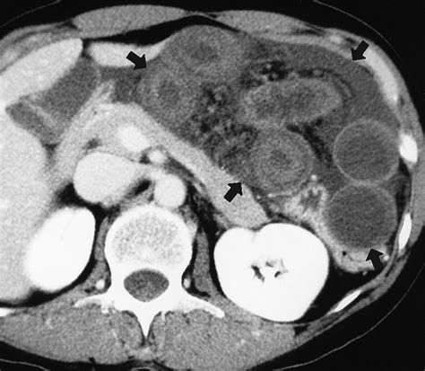 Ct And Mr Imaging Findings Of Bowel Ischemia From Various Primary