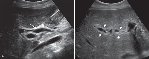 The Biliary Tree And Gallbladder Clinical Tree