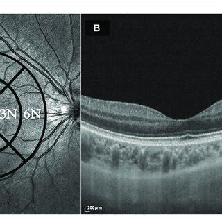 A Macular Regions According To The Early Treatment Of Diabetic Download Scientific Diagram