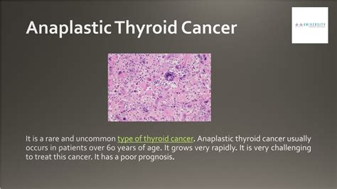 Ppt Types Of Thyroid Cancer Powerpoint Presentation Free Download