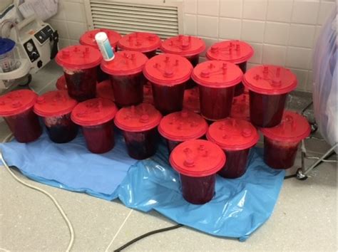 Adult Liver Transplantation Anesthetic Considerations Openanesthesia