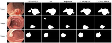 lightweight colon polyp segmentation algorithm based on improved deeplabv3