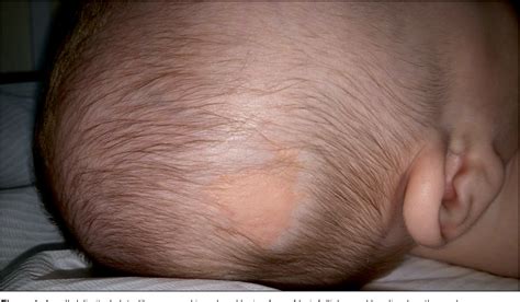 Neonatal Nevus