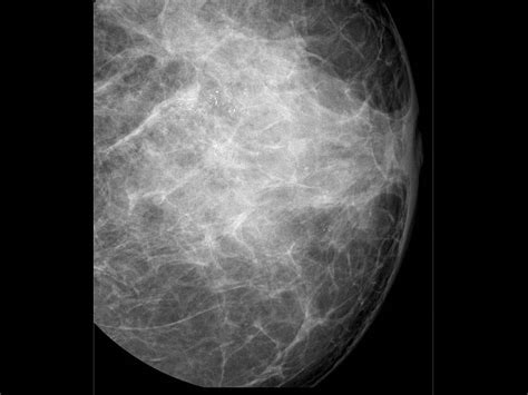 Atlas Of Breast Cancer Early Detection