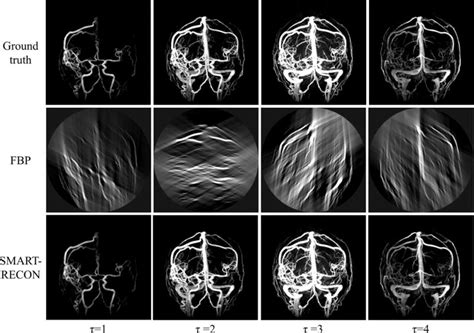 Mask Free Intravenous D Digital Subtraction Angiography IV D DSA From A Single C Arm
