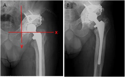 Case 4 A Radiographs Immediately Postoperatively And 6 Years Download Scientific Diagram