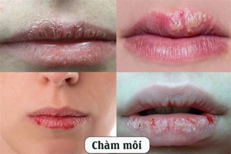 Chàm Môi 4 Nguyên Nhân Cách Chữa Và Cách Phòng Ngừa Hiệu Quả