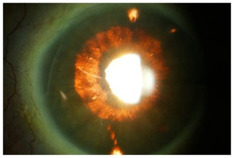 Iris Transillumination In Slit Lamp Examination Clearly Showing Download Scientific Diagram