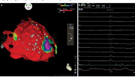 Figure 1 From Endoepicardial Ablation Of Ventricular Arrhythmias With Contact Force Sensing