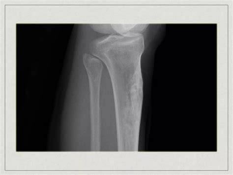 Chest Wall Tumor Pdf