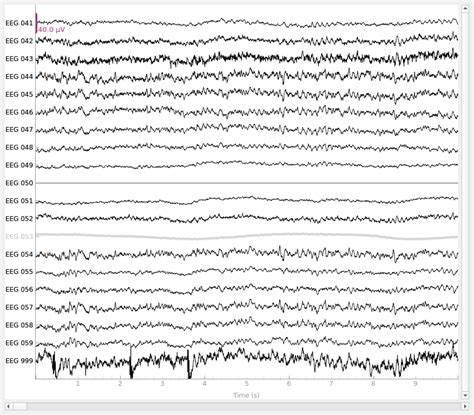 Setting The Eeg Reference — Mne 1101 Documentation