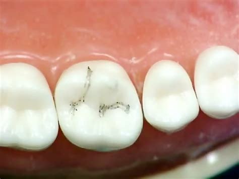 تراش حفره کلاس 1 بر روی دندان مولر اول ماگزیلا