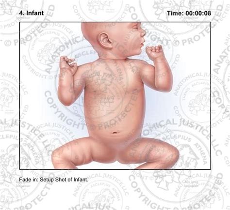 Tetralogy Of Fallot And Transannular Patch Aneurysm Storyboards