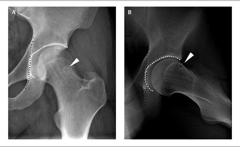 Figure 2 From Detection Of Acetabular And Proximal Femoral Radiographic