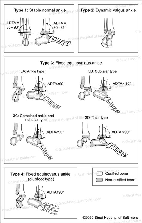 Five Fibular Hemimelia Classification Systems International Center For Limb Lengthening