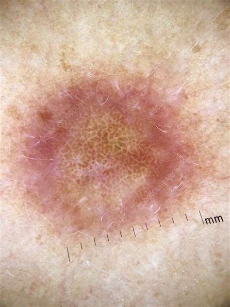 Dermatofibroma Dermoscopy Stock Image C0611535 Science Photo