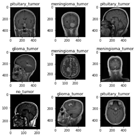 Figure 1 From Vision Transformers For Brain Tumor Classification Semantic Scholar