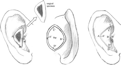 Reconstruction Of Anterior Auricular Conchal Defect After Malignancy