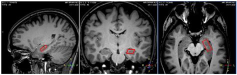 Hippocampal Metabolic Alterations In Amyotrophic Lateral Sclerosis A