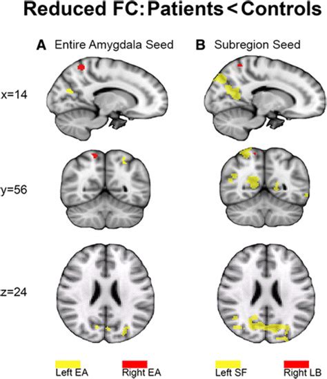 Areas Of Reduced Functional Connectivity In Asd A Significant P