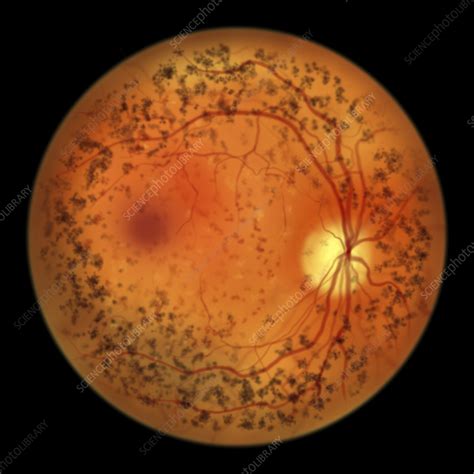 Autosomal Dominant Vitreoretinochoroidopathy Illustration Stock Image F0378623 Science
