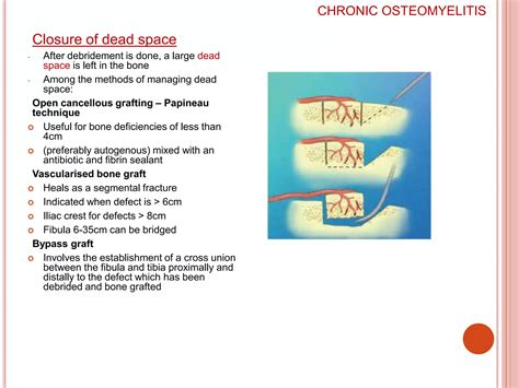 Osteomyelitis Pptx