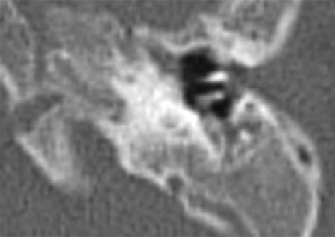 Inner Ear Malformations And Implantation Ento Key