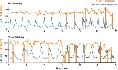 Representative Raw Ctg Records From The Normal And Abnormal Deliveries Download Scientific