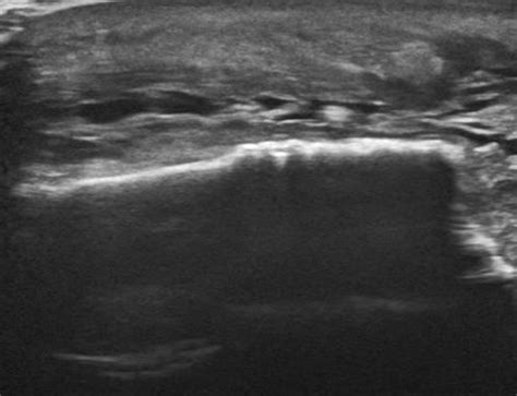 Musculoskeletal Joints And Tendons 6 2 Elbow Case 6 2 5 Olecranon Bursa And Triceps Tendon