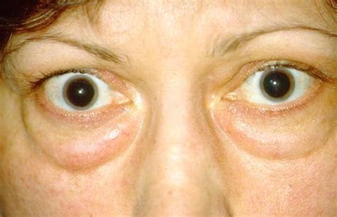 Periorbital Edema Causes And Treatment In The Human