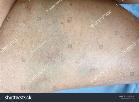 Skin Disease Lesion Ecchymosis Vasculitis库存照片1498776188 Shutterstock