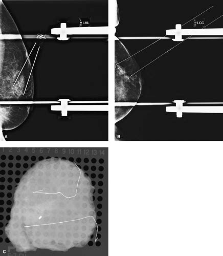 Needle Localization Biopsy Of Nonpalpable Breast Lesions Plastic