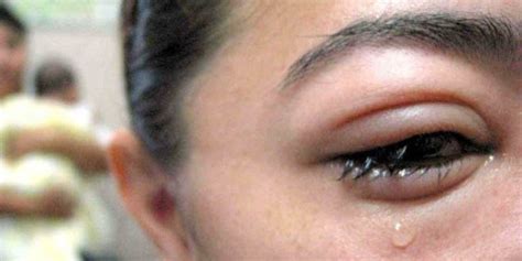 Presenta Conjuntivitis Hemorrágica Tendencia A La Baja El Informador