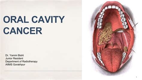 Oral Cavity Radiology Pptx Radiation Oncology Pptx