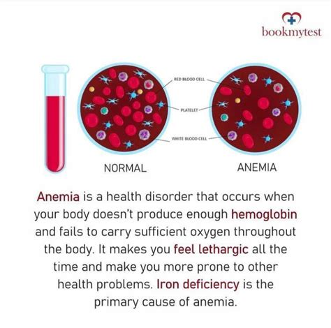 Iron Deficiency Anemia Equation At Delia Garibay Blog