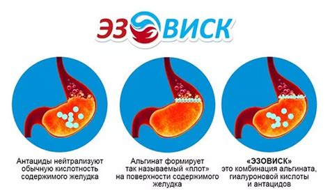 Гастроэзофагеальная рефлюксная болезнь | Симптомы и лечение от ...