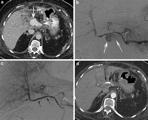 A 74 Year Old Woman With Extrahepatic Cholangiocarcinoma Who Underwent Download Scientific