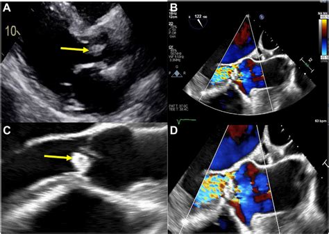 A Two Dimensional Transthoracic Echocardiography Parasternal