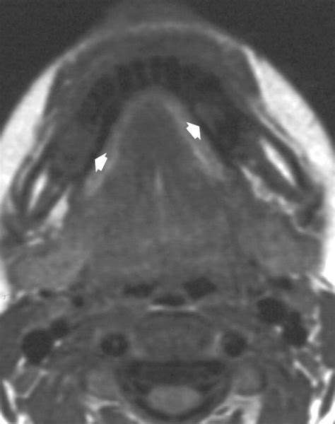 Imaging Characteristics Of Cherubism Ajr