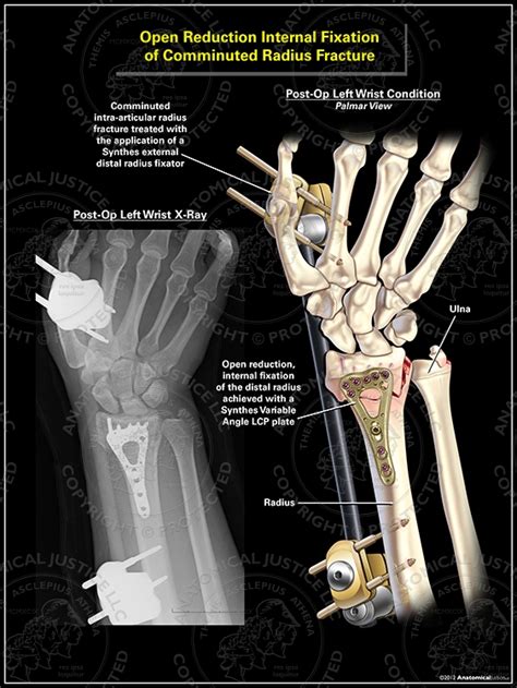 Open Reduction Internal Fixation Of Comminuted Radius Fracture