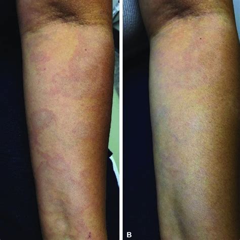 Edp Case 2 A Multiple Irregularly Shaped Gray To Blue Patches With A