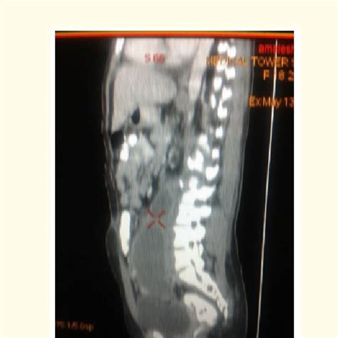 CT Abdomen Sagittal View Showing Abdominal Mass Conclusion This Case Download Scientific