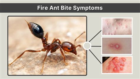 Fire Ant Bites Symptoms Treatment Identification With Pictures